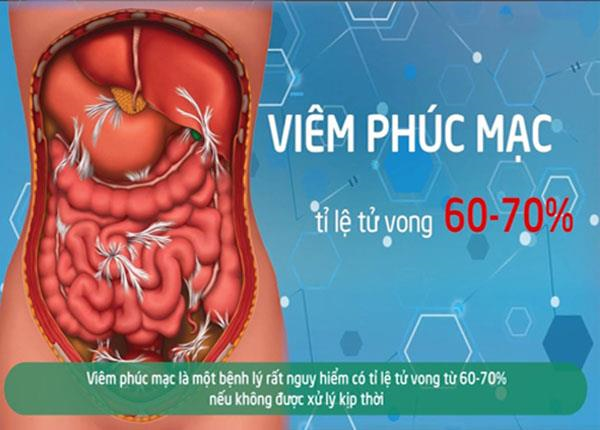 Viêm phúc mạc ruột thừa – Chớ nên chủ quan